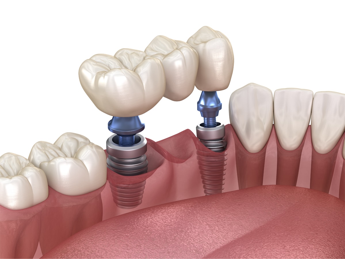 Dental Implants in Blaine Andover MN