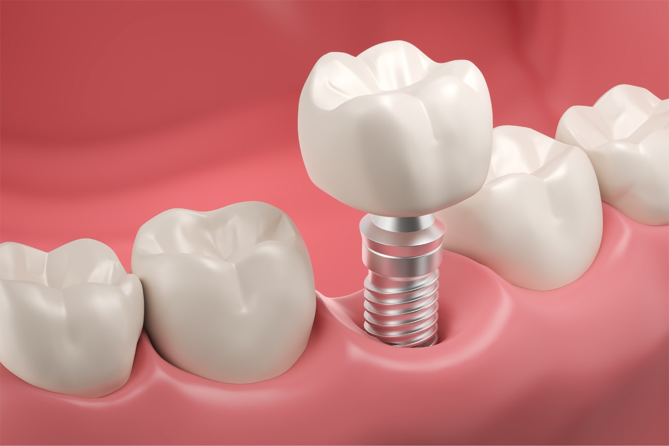 Dental Implants in Blaine Andover MN