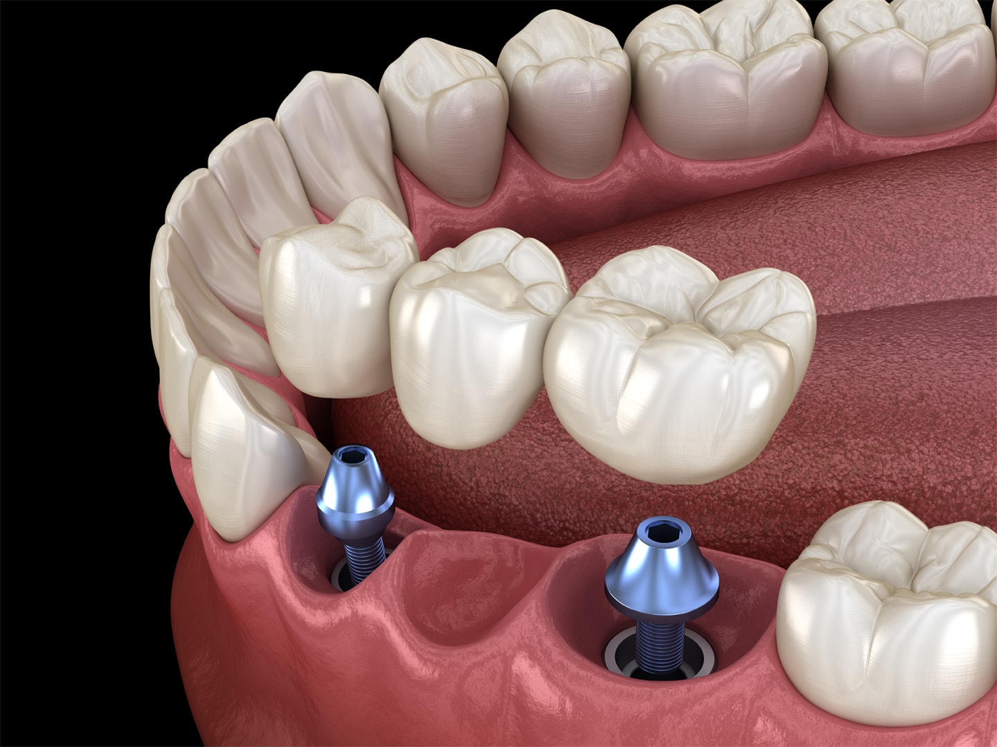 Dental Bridges in Blaine Andover MN